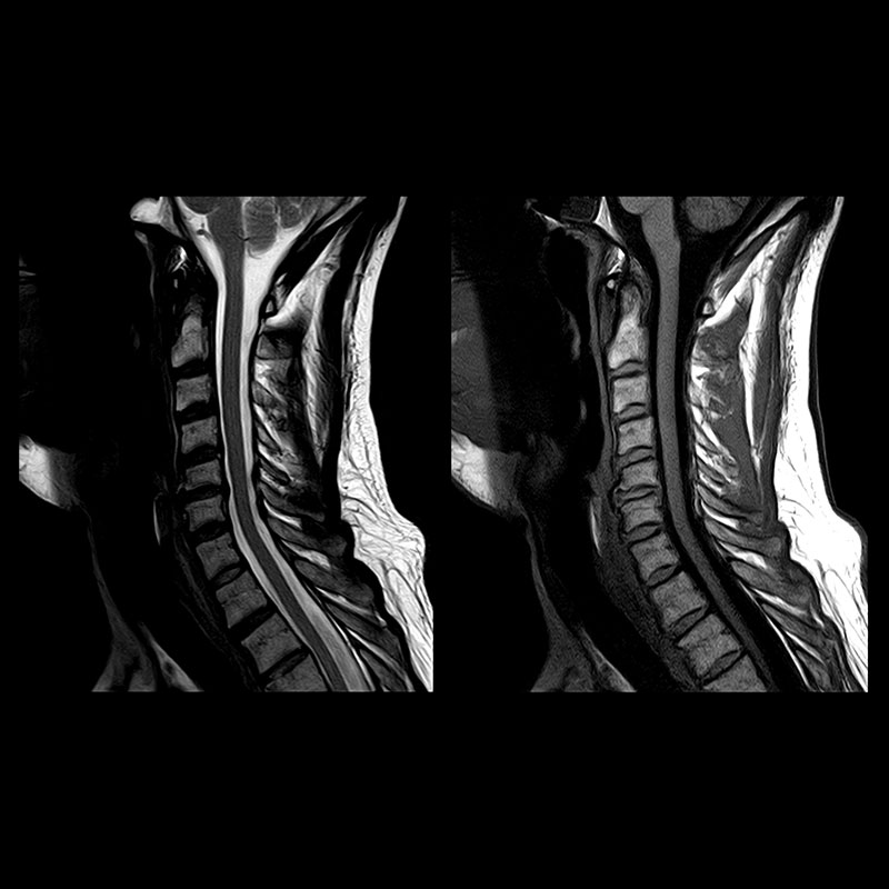 Spine | Vantage Galan 3T Clinical Gallery | MRI | Magnetic Resonance ...