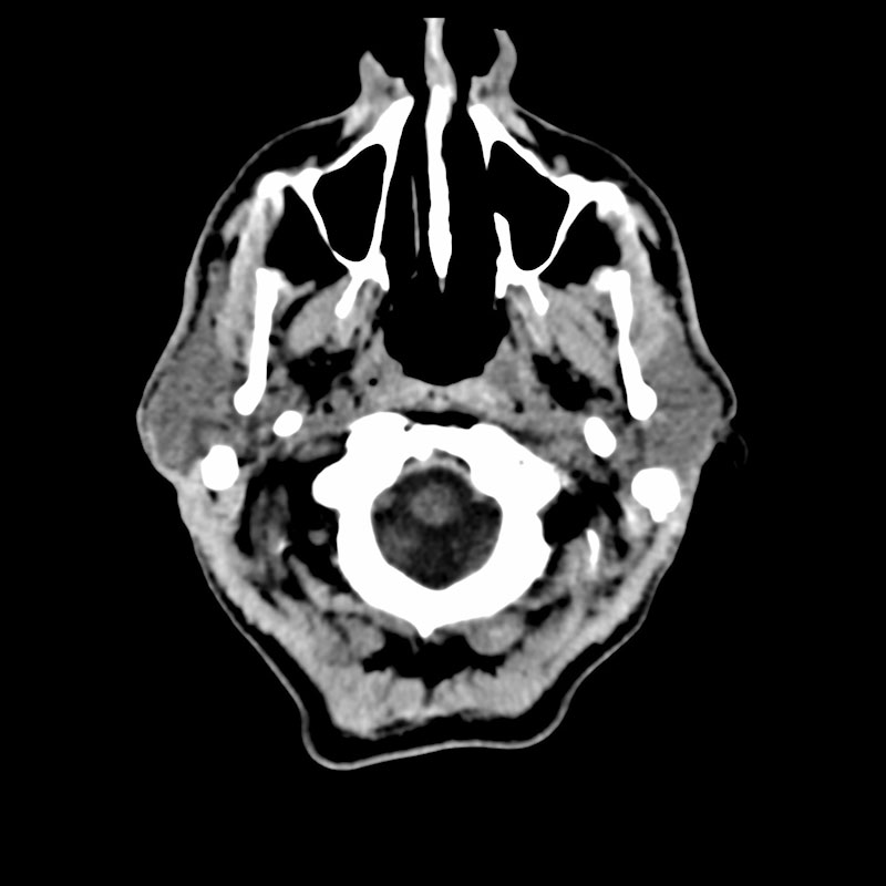 Head & Neck | Aquilion Prime SP Clinical Gallery | Computed Tomography ...