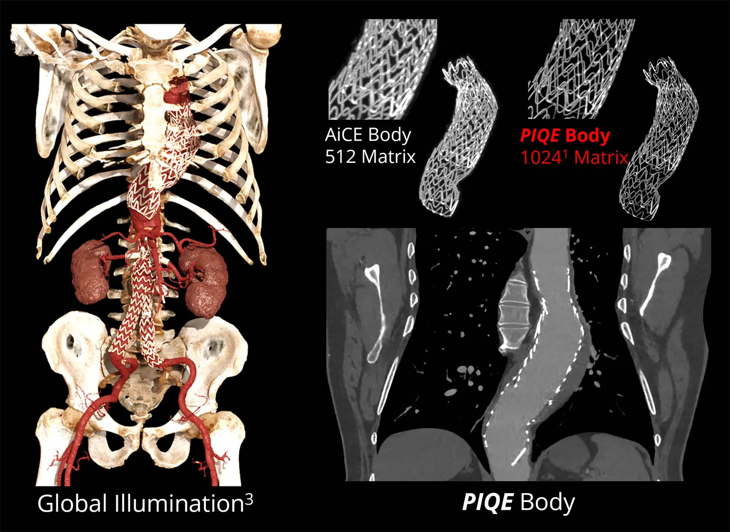 CTA Aorta with PIQE Body