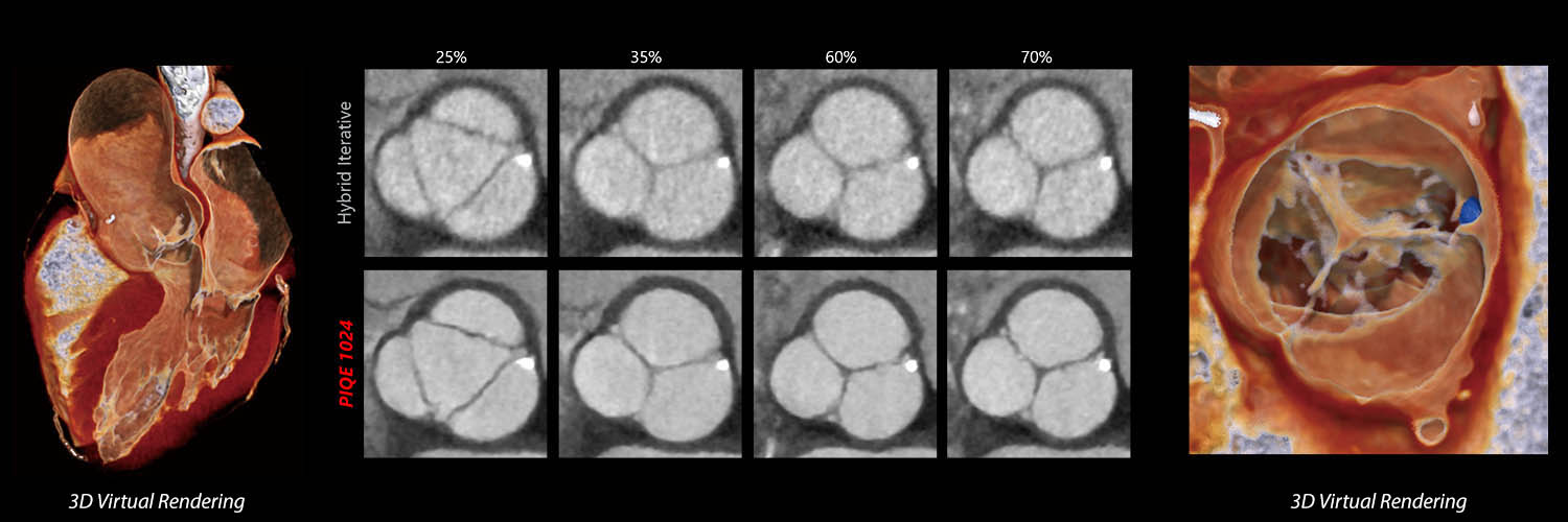 High Resolution Aortic Valve
