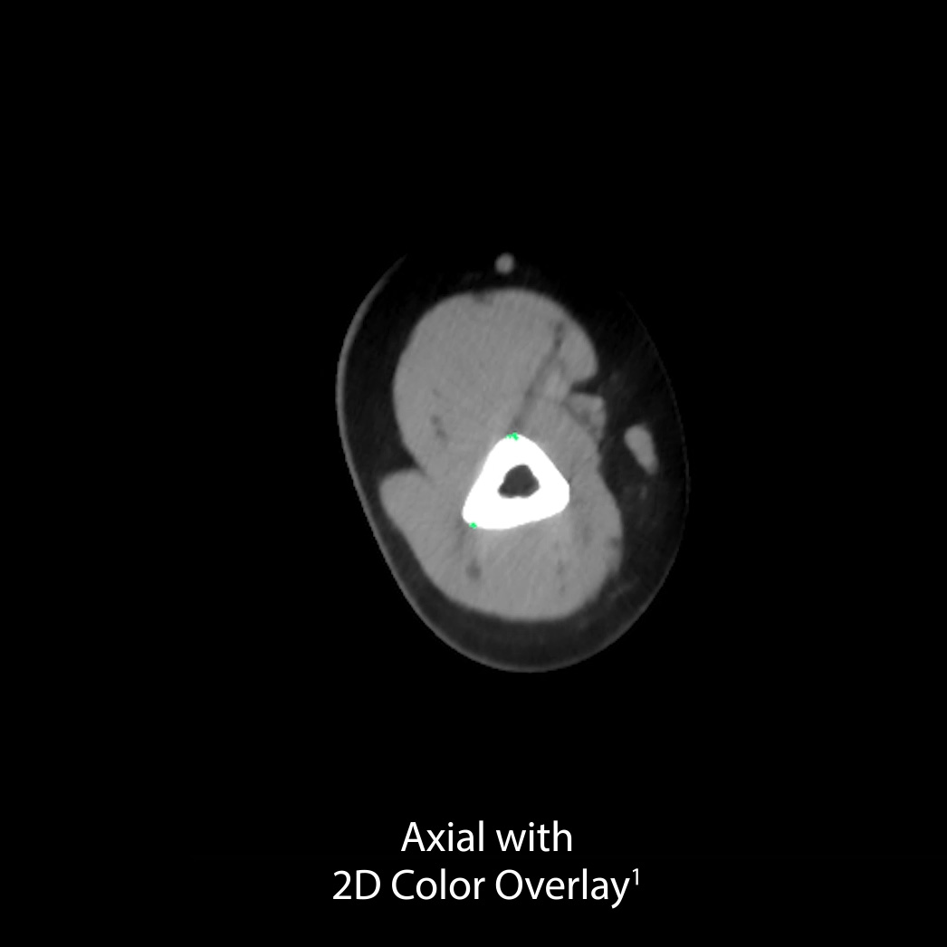 Spectral* Elbow for Gout Analysis