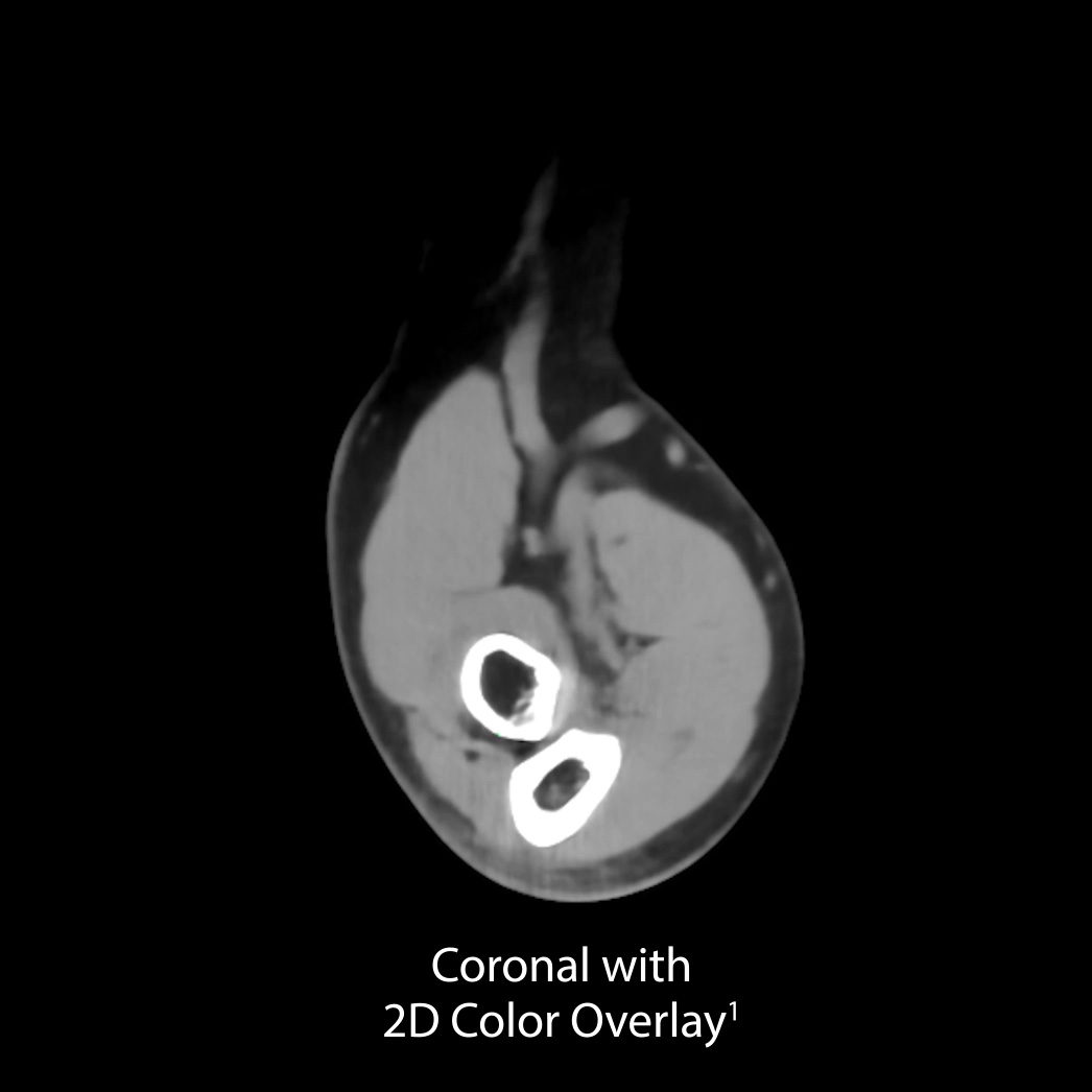 Spectral* Elbow for Gout Analysis