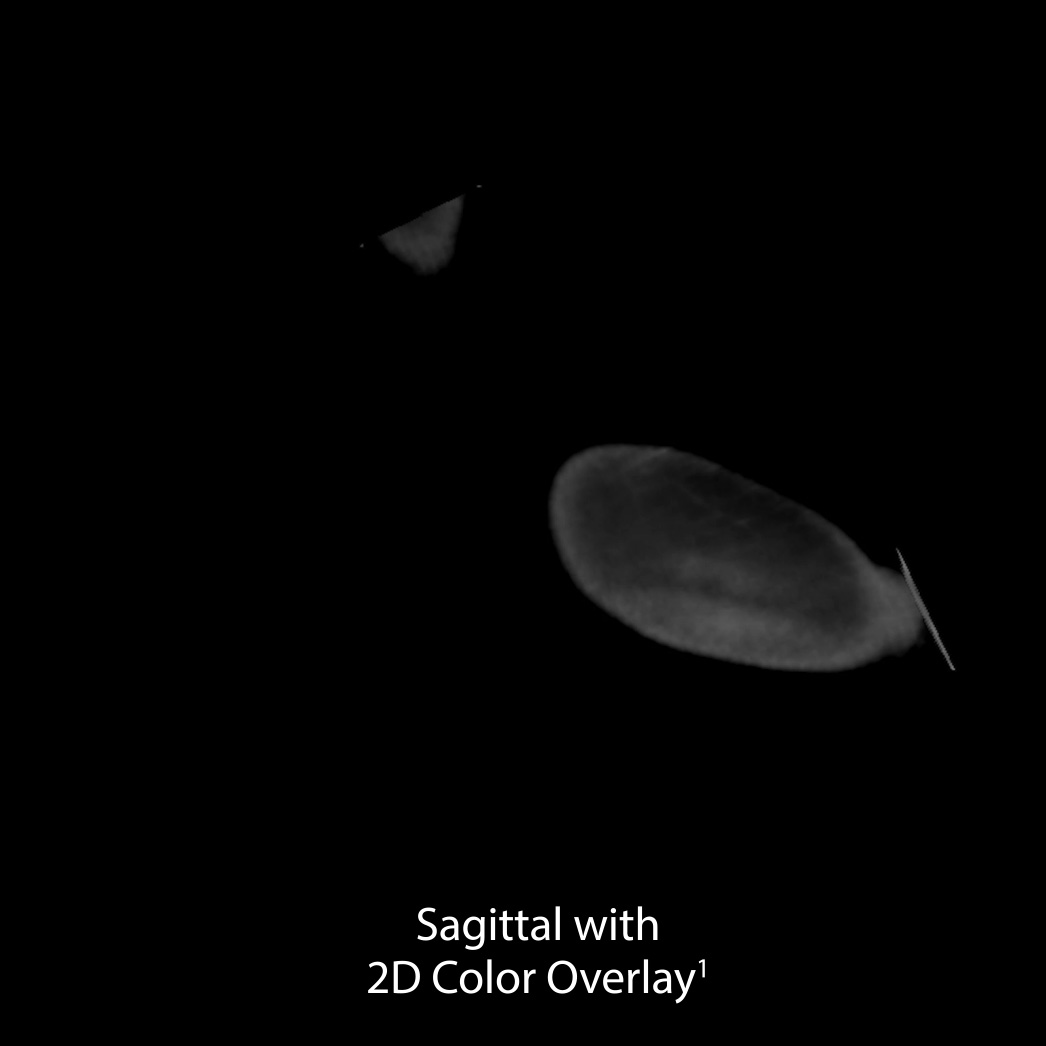 Spectral* Elbow for Gout Analysis