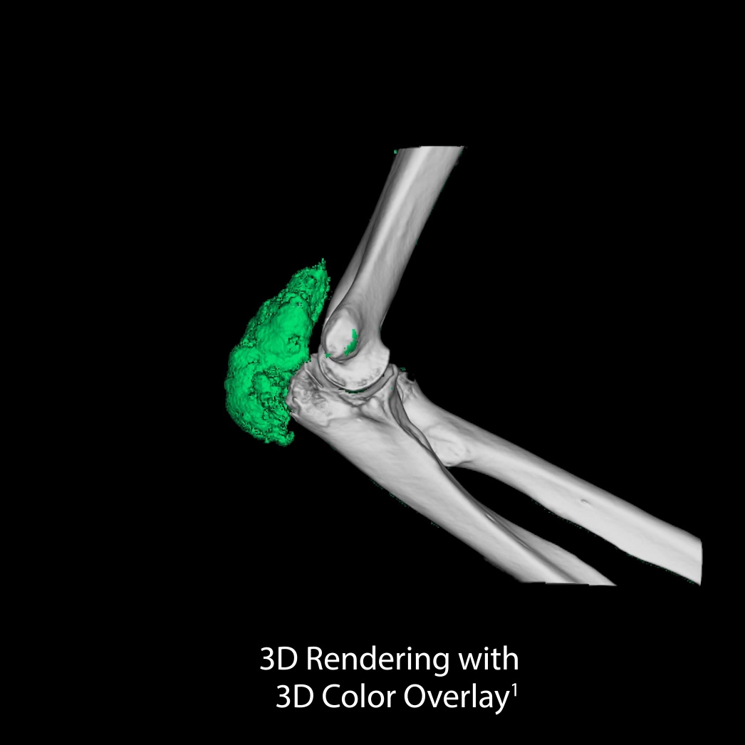 Spectral* Elbow for Gout Analysis