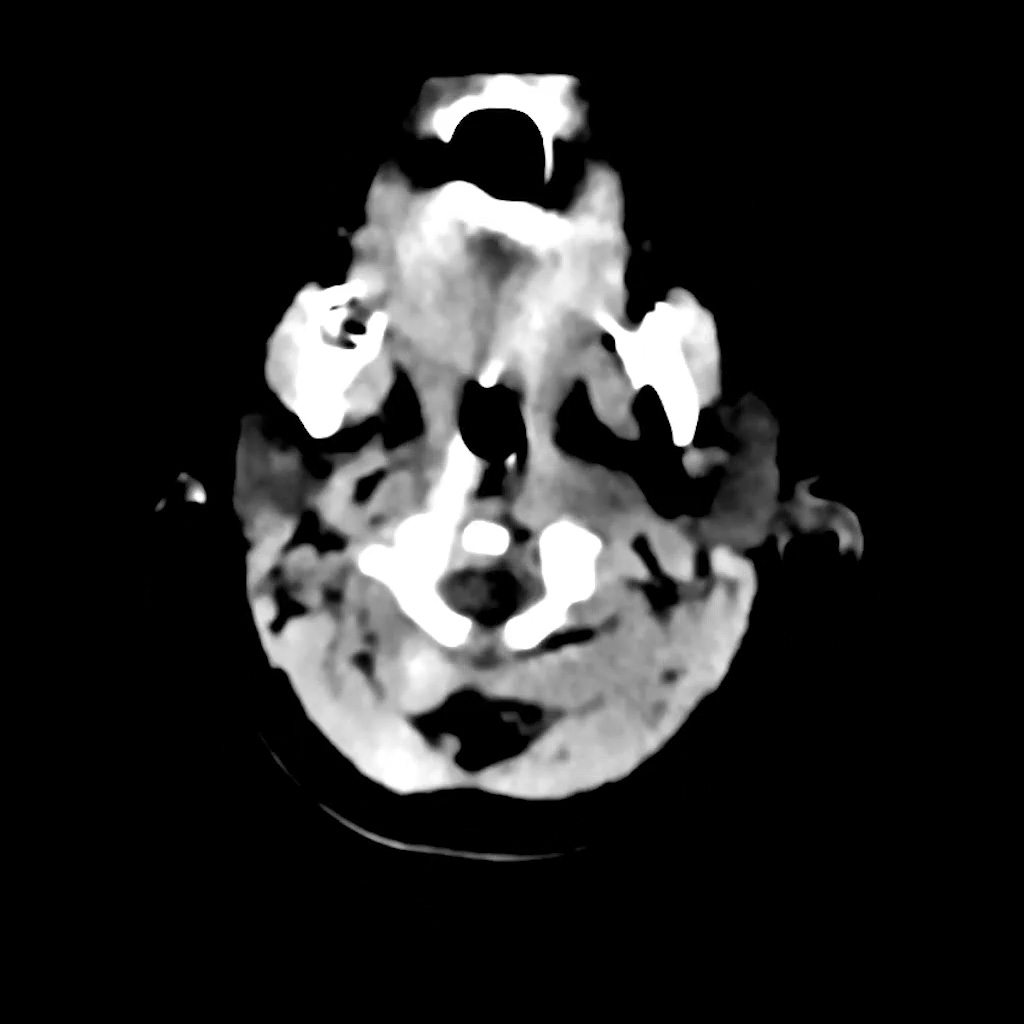 4 month old - Volume Brain