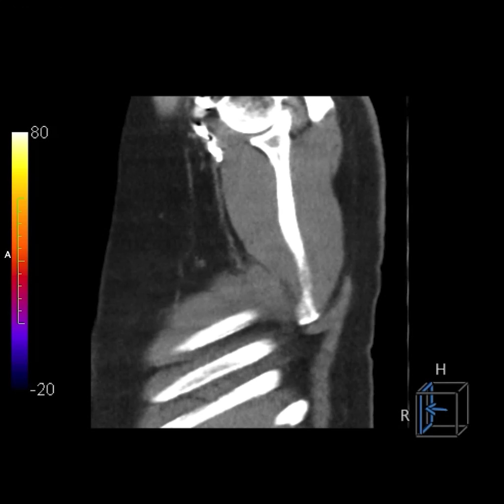 Sagittal SCT