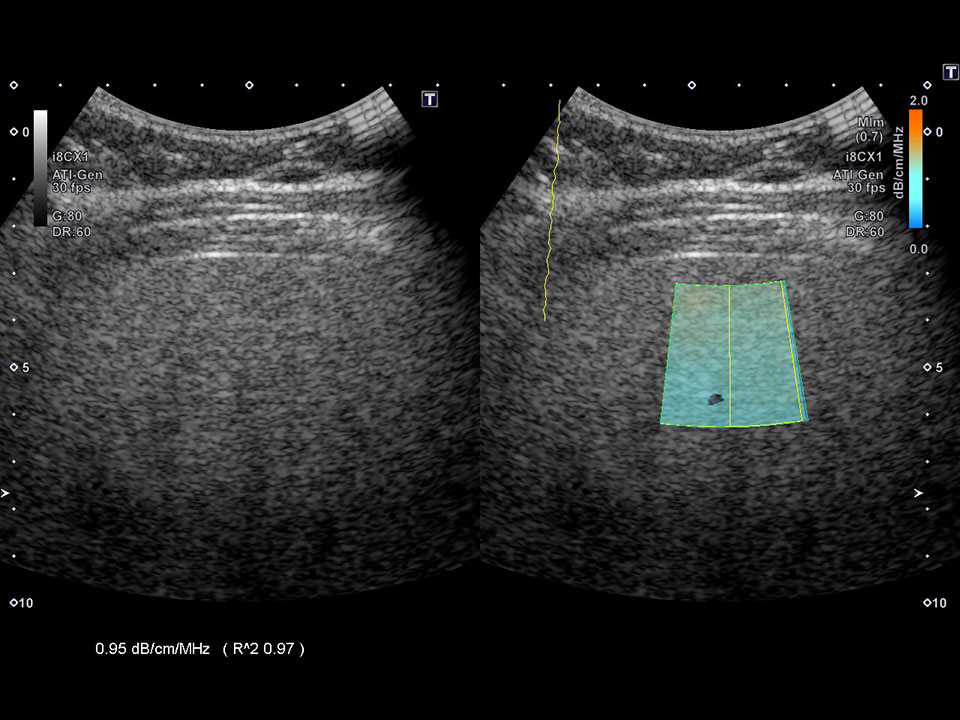 Liver Analysis Package | Aplio i-series Clinical Gallery | Ultrasound ...