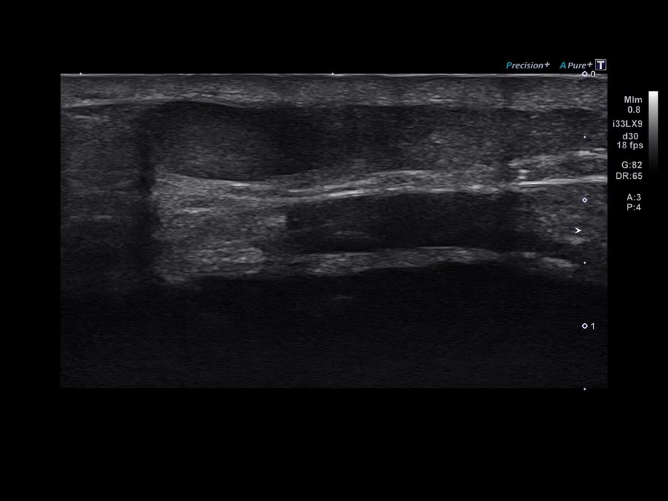 New Transducers | Aplio i-series Clinical Gallery | Ultrasound | Canon ...