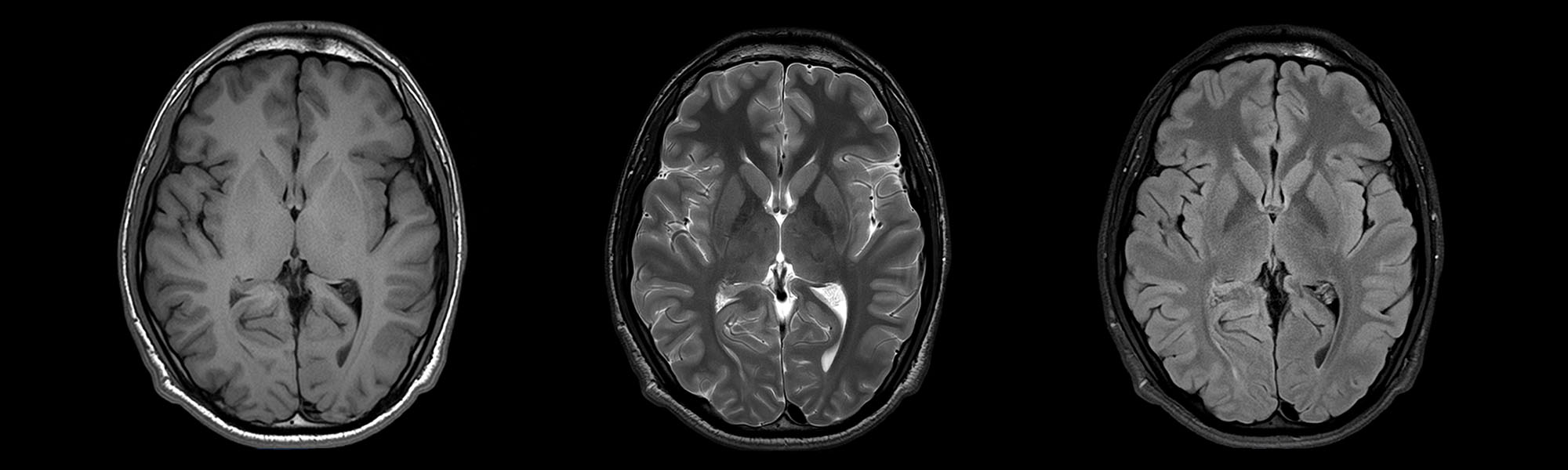 High Resolution Brain