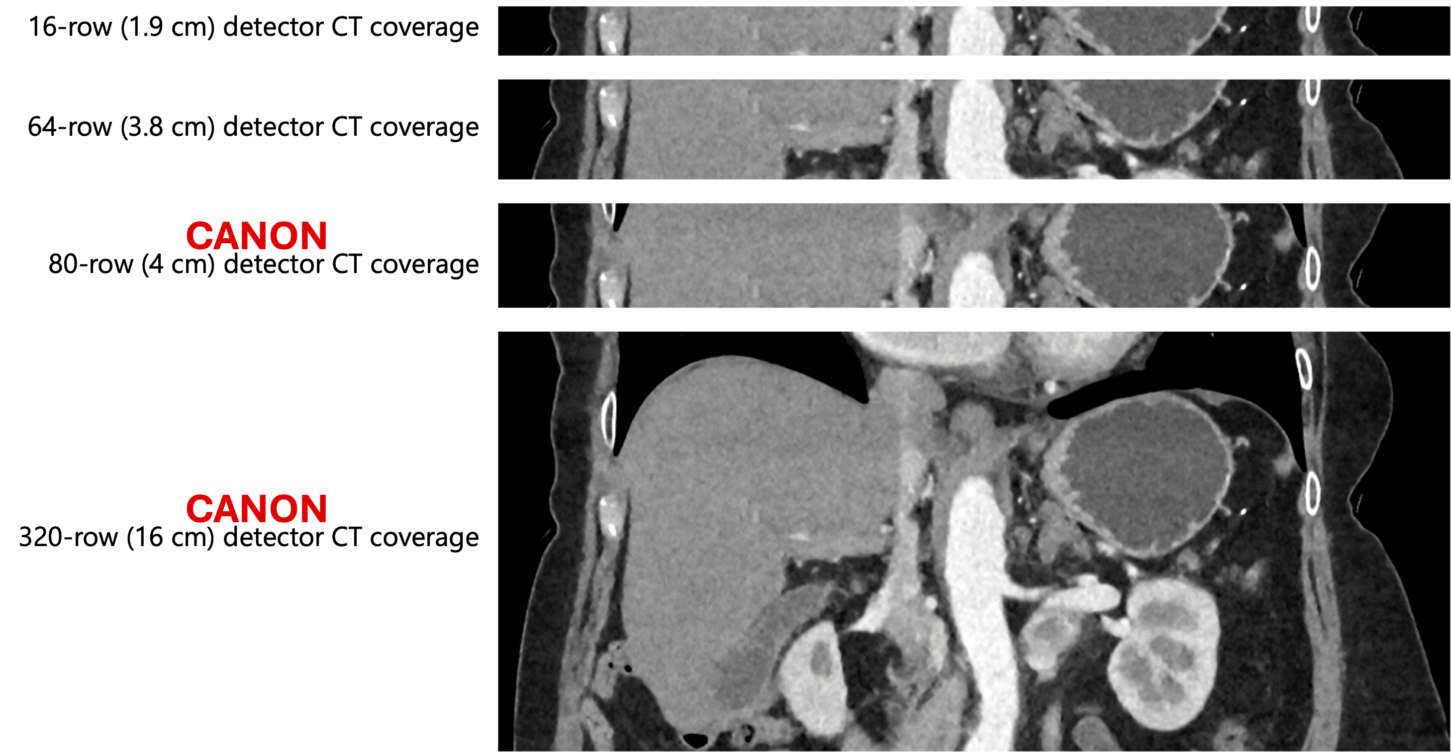 16-row (1.9 cm) detector CT coverage, 64-row (3.8 cm) detector CT ...
