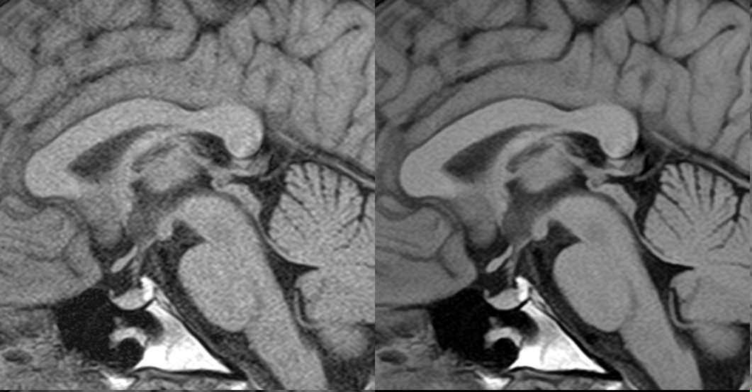 Advanced intelligent Clear-IQ Engine (AiCE) | MRI | Magnetic Resonance ...