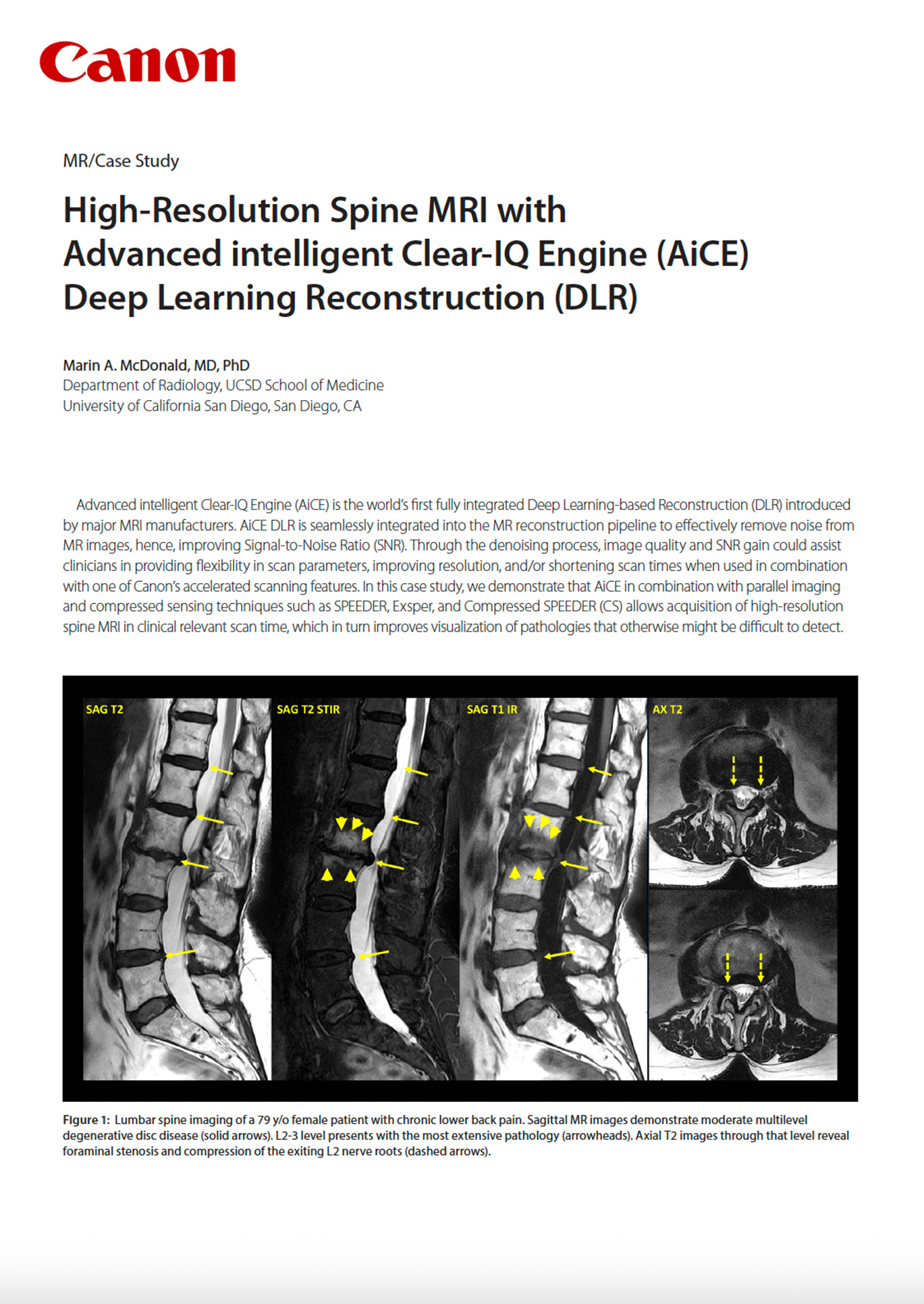 High-Resolution Spine MRI with Advanced intelligent Clear-IQ Engine ...
