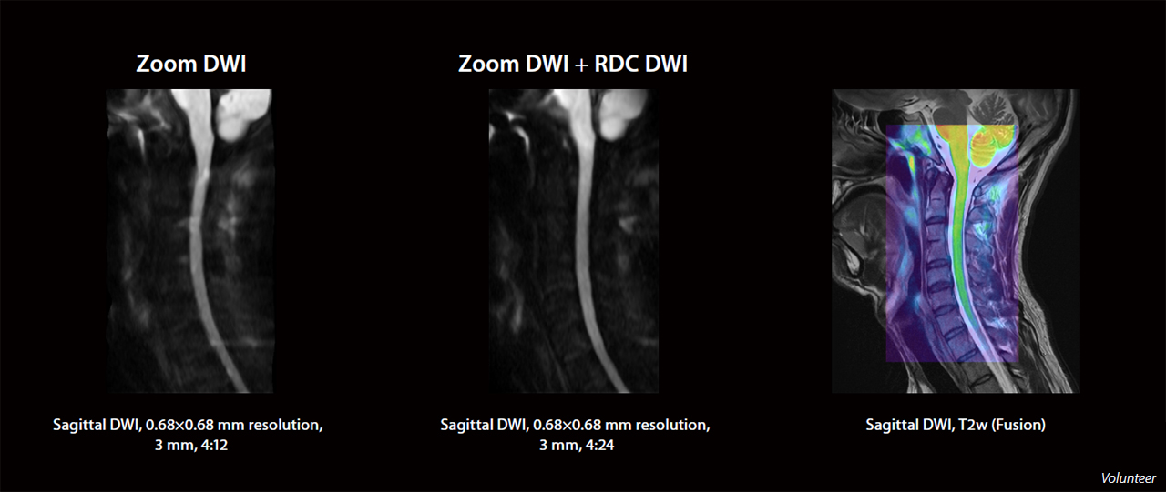 Zoom DWI